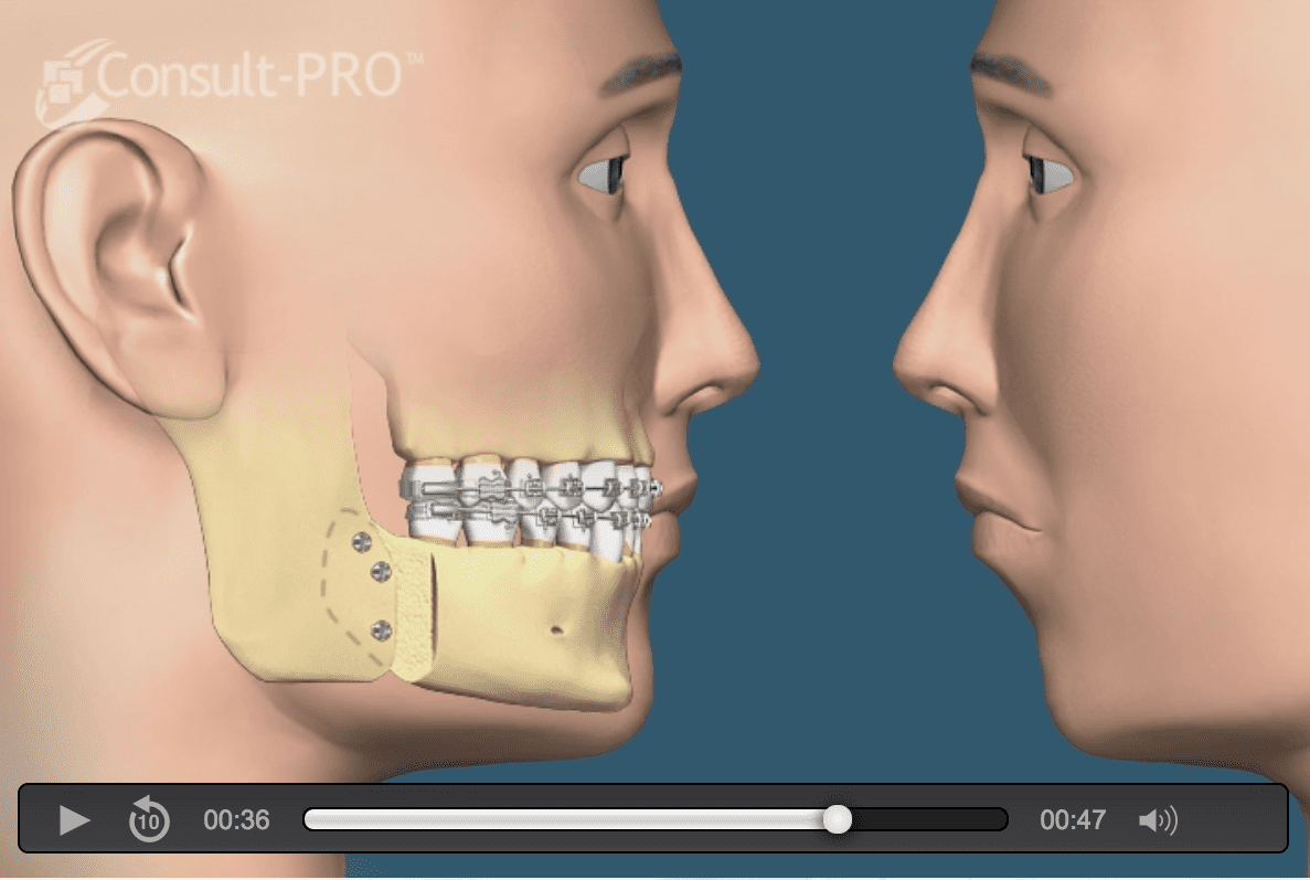 Jaw Surgery Naperville, IL | Oral and Facial Surgery of Naperville